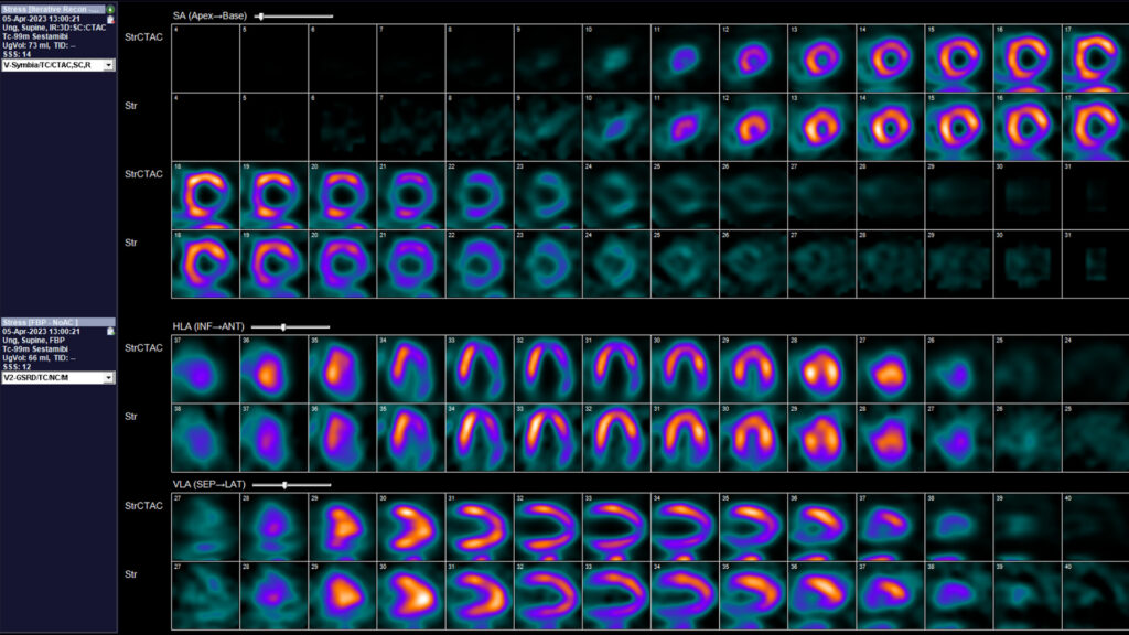CE ESTE SCINTIGRAFIA DE CORD? - THE VISION